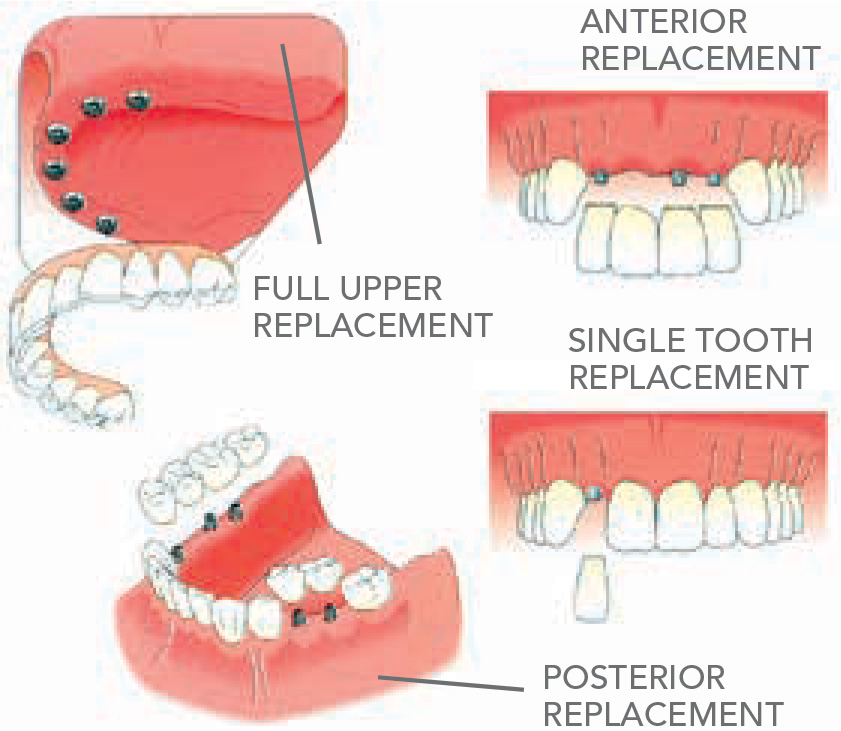 Complete Lower Replacements - Impressions Dental Centres