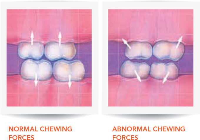 TMJ Syndrome - Impressions Dental Centres