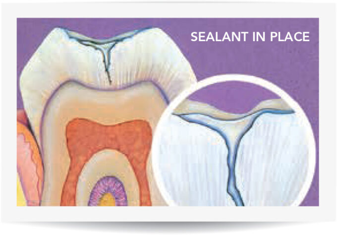 Pit and Fissure Sealants - Impressions Dental Centres