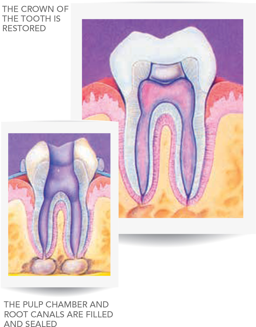 Root Canals - Impressions Dental Centres